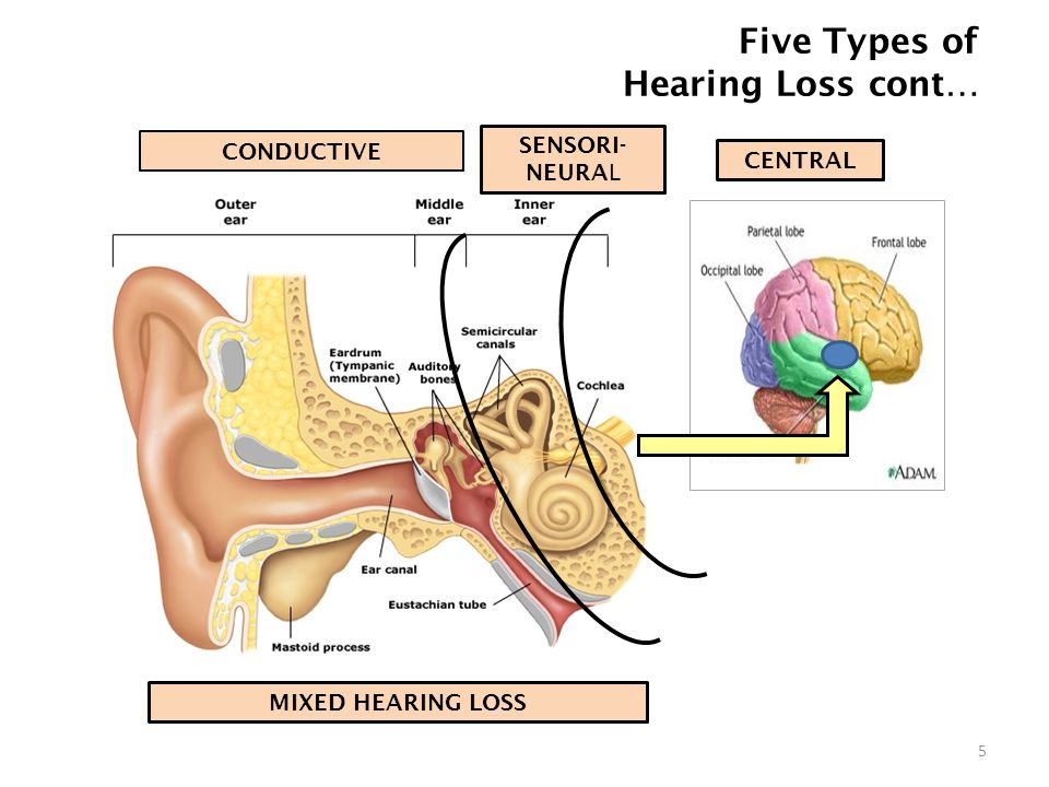 Types of Hearing Loss & Best Solution - learn more
